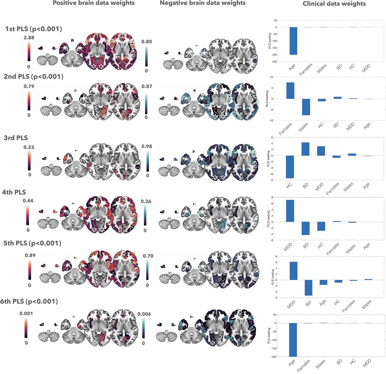 Multivariate brain morphological patterns across mood disorders: key roles of frontotemporal and ...